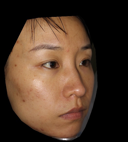 Acne Object Detection Dataset V23 2024 07 27 3 09am By Javad Rezaei