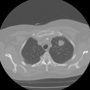 LIDC-image Classification Dataset by YZU