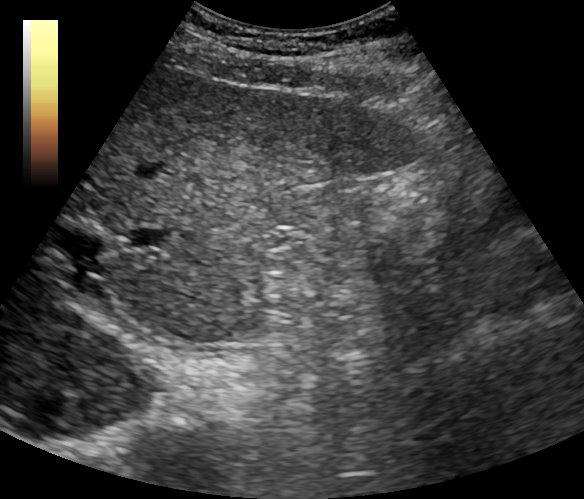 liver_ultrasound Object Detection Dataset by Gallstones