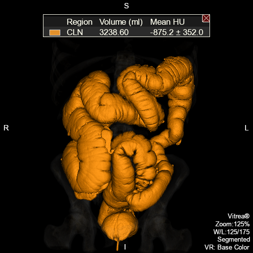 colon Object Detection Dataset and Pre-Trained Model by Terkirdag Namik ...