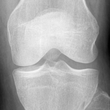 knee osteoarthritis Classification Model by knee OA