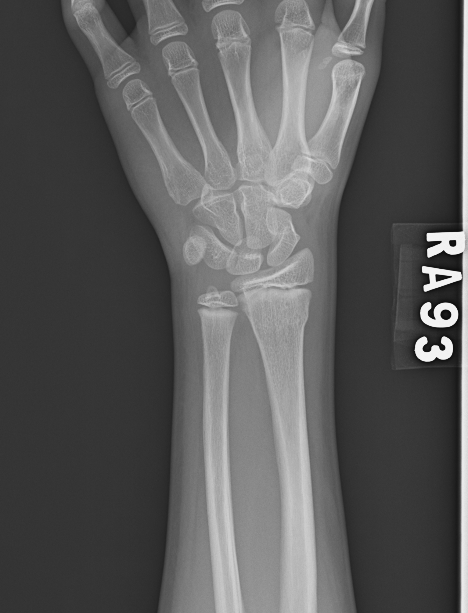 Bone Fractures Object Detection Dataset And Pre Trained Model By School