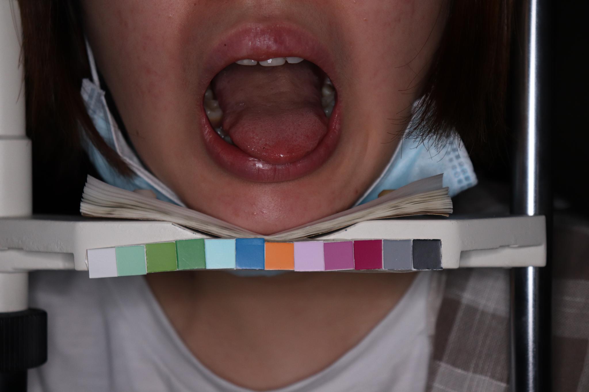 kawasaki_disease_tongue Object Detection Dataset and Pre-Trained Model by Joey Lin