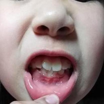 oral_teeth Object Detection Dataset by project-eeemb