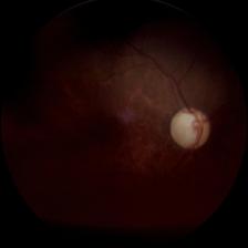 multi retinal disease classifica Classification Dataset and Pre-Trained ...