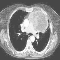 Oncoscan lung test - Roboflow Universe