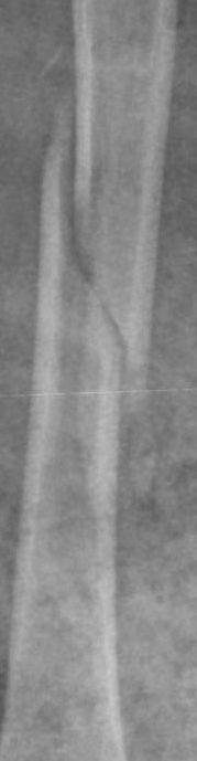 Tibia_F4 Object Detection Dataset by MSc