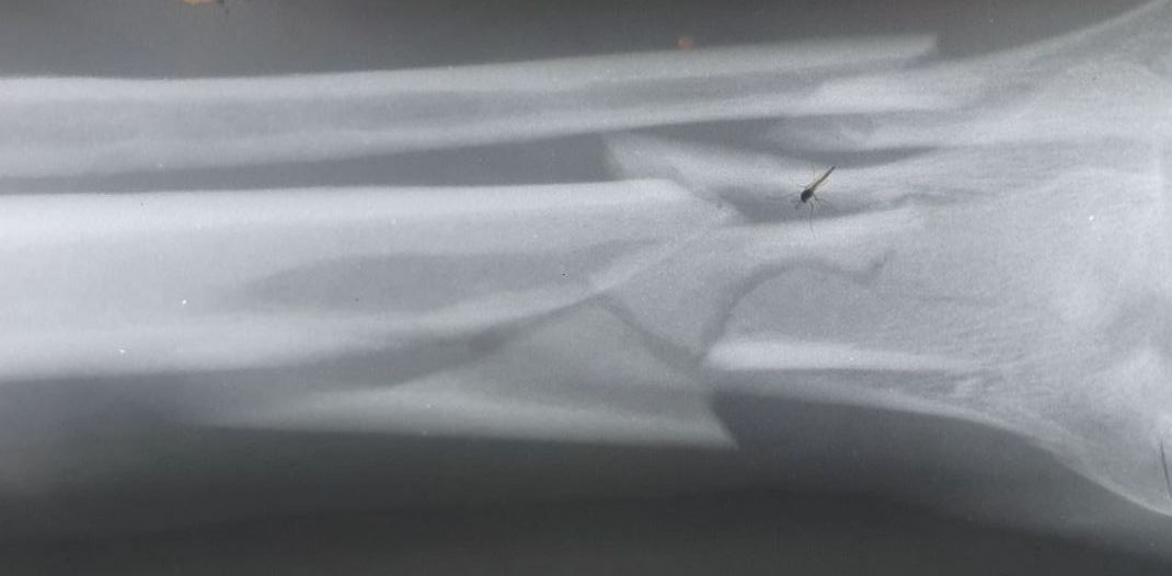 Tibia_All_Gr Object Detection Dataset and Pre-Trained Model by MSc