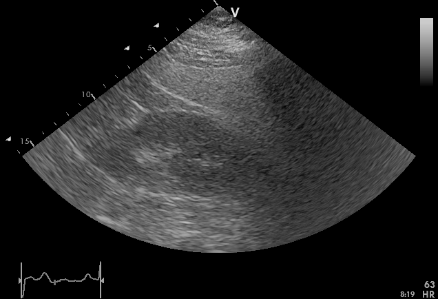 liver_cancer Semantic Segmentation Dataset by Joe Klepich