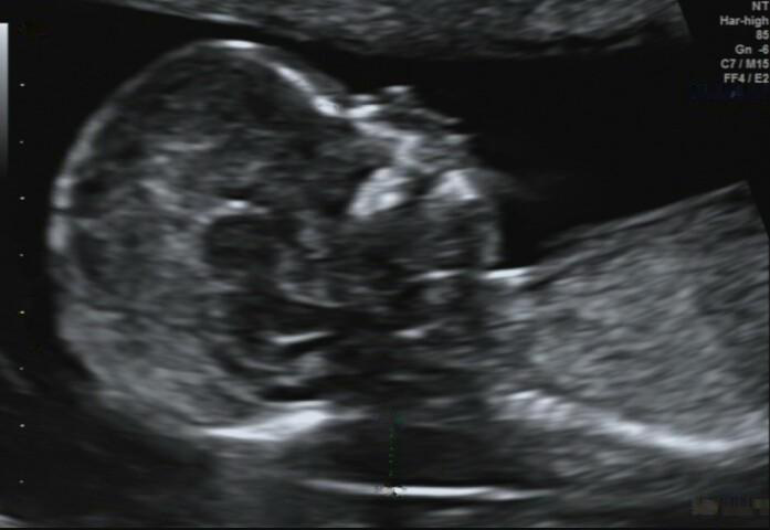 Fetus Object Detection Object Detection Model By Dr Ambedkar Institute