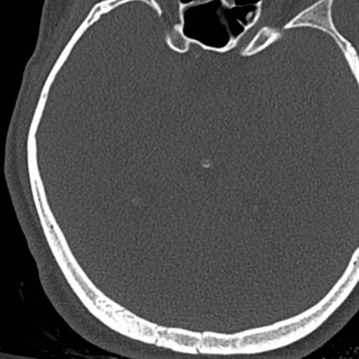 Bone Fracture Object Detection Dataset By Tumor Detection