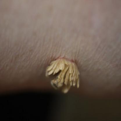 skin-classificationv3 Object Detection Model by yolov5skinclassification