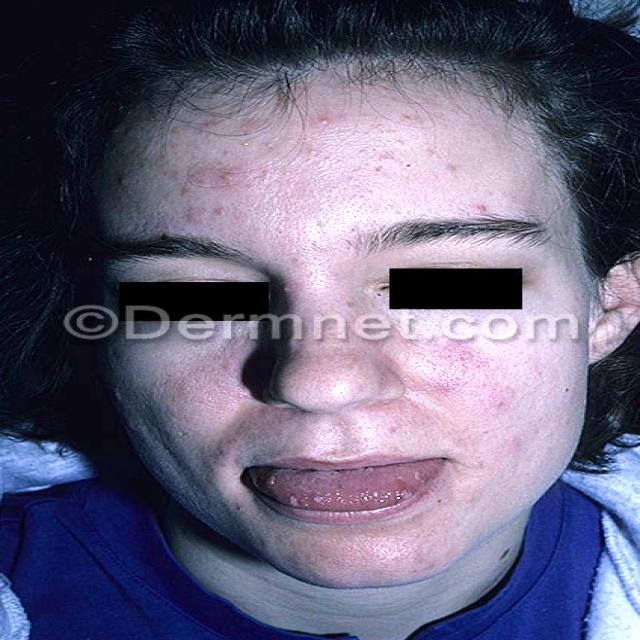 skin-classification Object Detection Dataset and Pre-Trained Model by ...