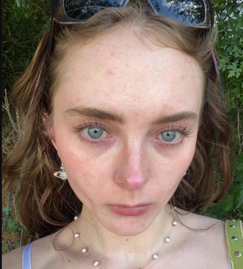 Acne Instance Segmentation Model by mm