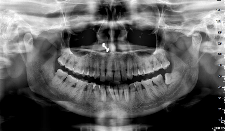 Dental Decay Detection Object Detection Dataset and Pre-Trained Model by Kaveri GC