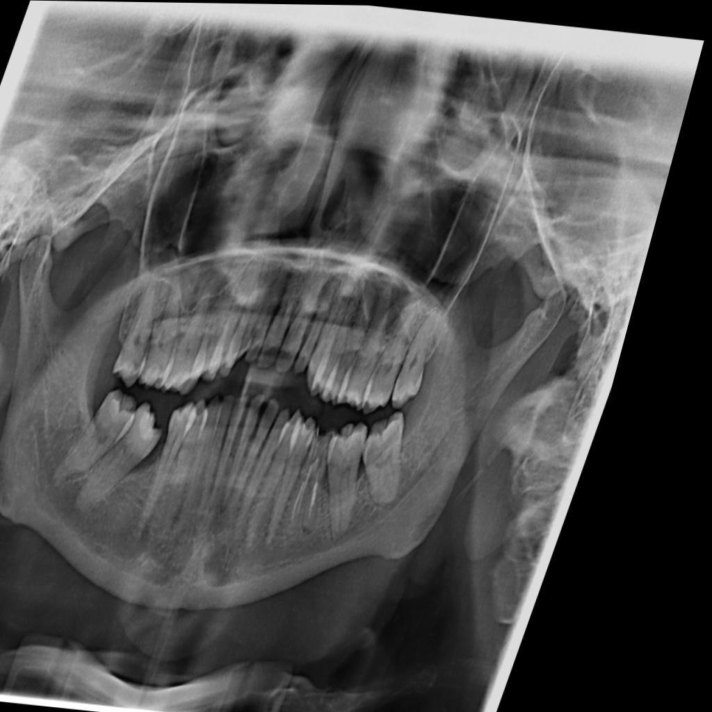 Dental Object Detection Dataset And Pre Trained Model By Kaveri Gc