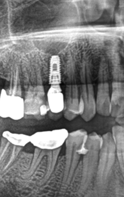 Dental Defects Object Detection Dataset And Pre Trained Model By Capstone Team