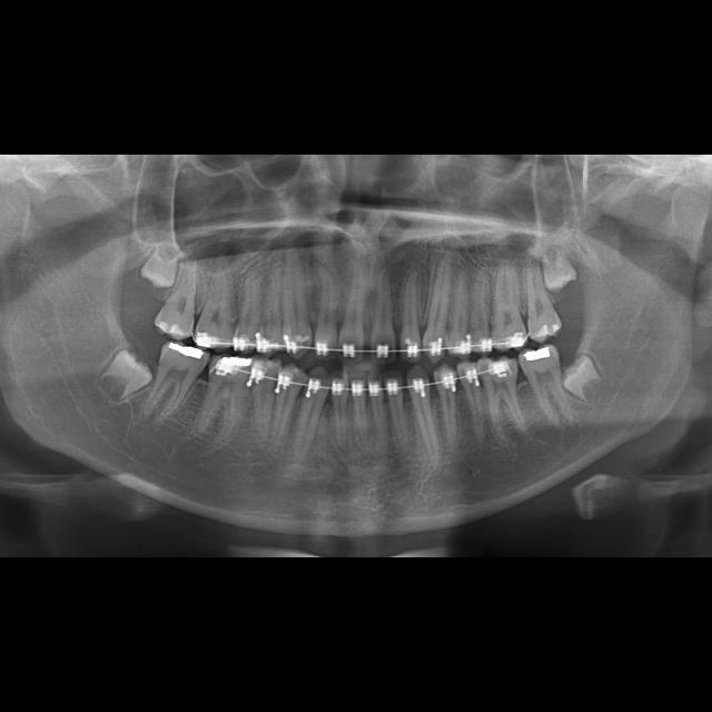 Caries Detection Object Detection Dataset And Pre Trained Model By Advance Dental Hospital