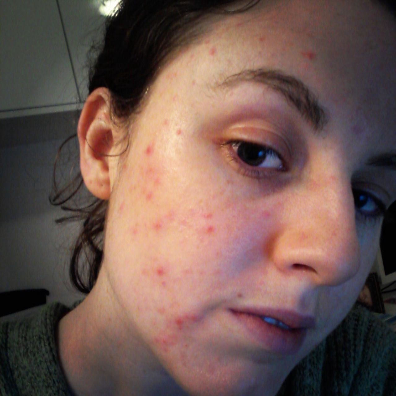 SKIN CONDITION OF FACE Classification Dataset by ANIS