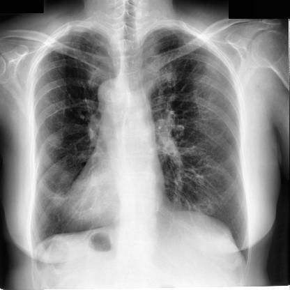 lung Object Detection Dataset by Healthcare