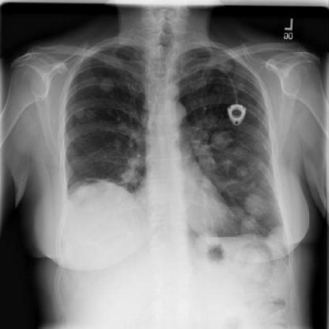 lung Object Detection Dataset by Healthcare