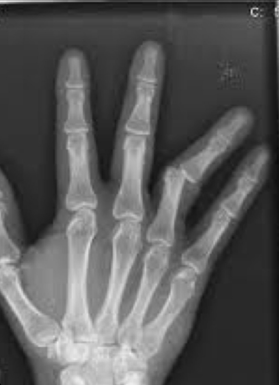 X-ray hands Object Detection Model by tugusyana