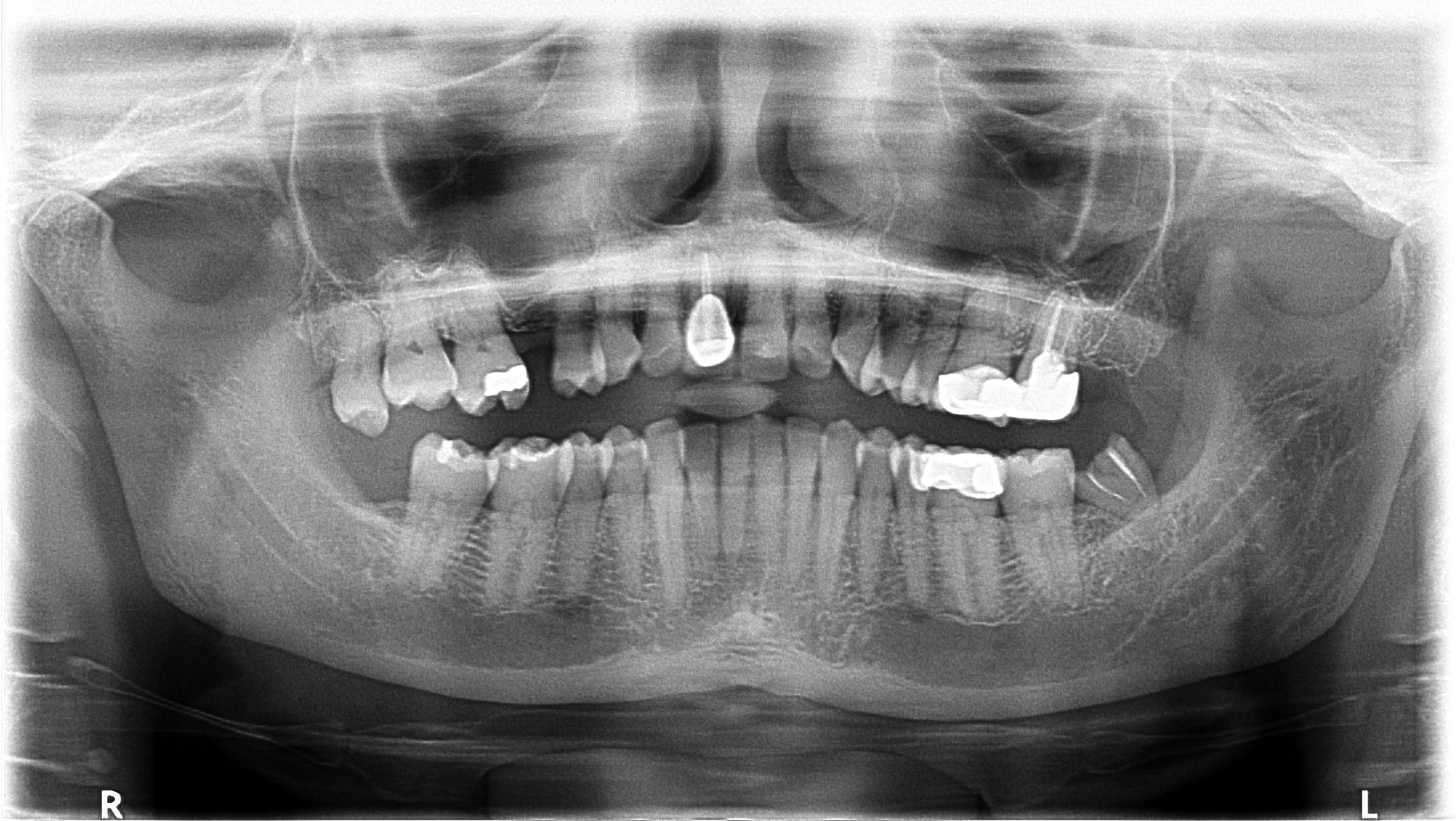 teeth diseases Instance Segmentation Dataset by My workspace