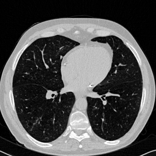 lung-nodule Object Detection Dataset by Huy Nguyn