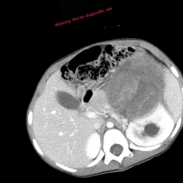 Wilms tumor dataset Classification Model by WilmsTumor
