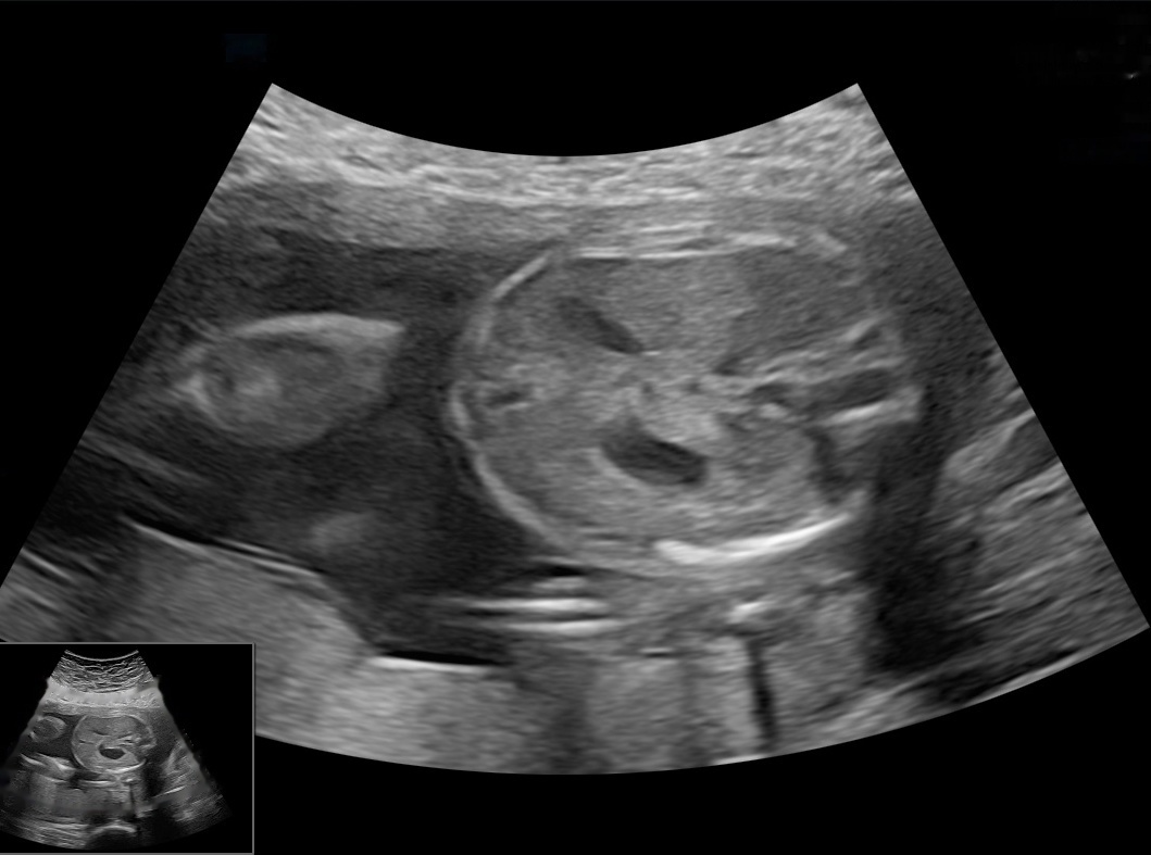 Gallbladder Instance Segmentation Dataset and Pre-Trained Model by Test