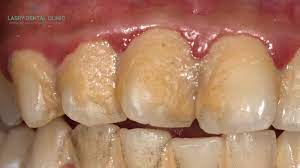 caries,healthy,cavity,plaque,gum swelling merge 6 Object Detection ...