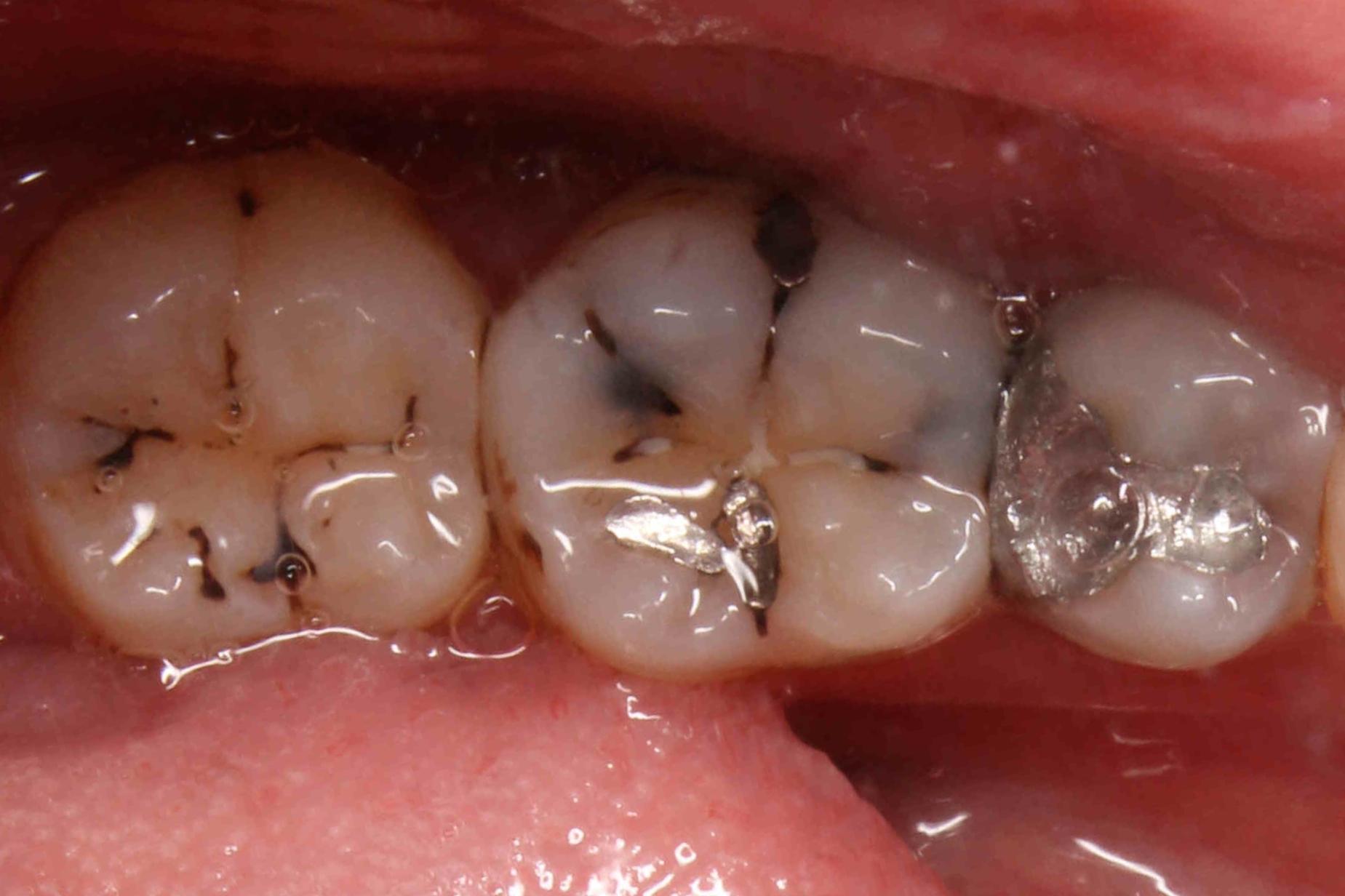 caries,healthy,cavity,crack merge 3 Object Detection Dataset by dental data