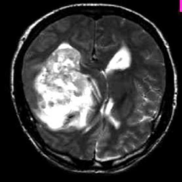 Brain Tumour detection (MRI) Object Detection Dataset and Pre-Trained ...