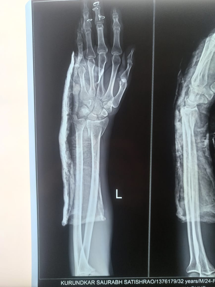 Wrist Fracture Object Detection Dataset By Chunnumunnu