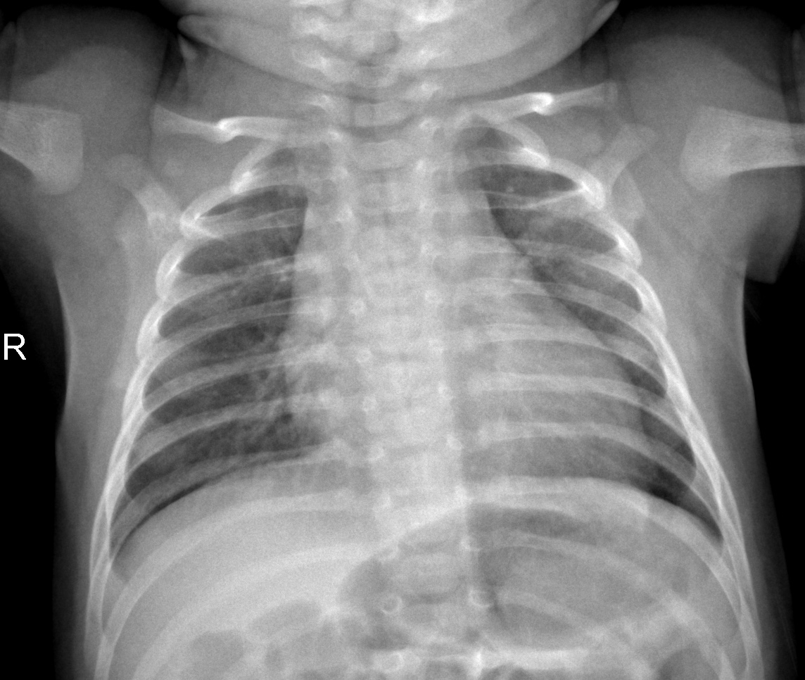 classification of pneumonia Classification Dataset by NUST