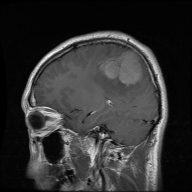 OBJECT SEGMENTATION BRAIN TUMOR Instance Segmentation Dataset and Pre-Trained Model by azky ...
