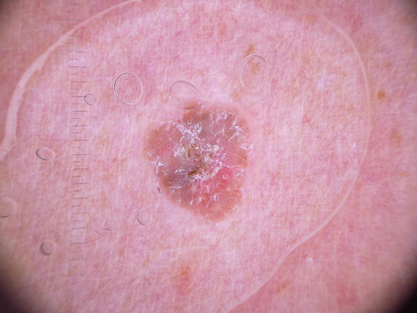 skin Classification Model by CXRDataset