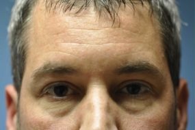 Dark_Circles_Dataset Instance Segmentation Model by Sedanur Ylmaz