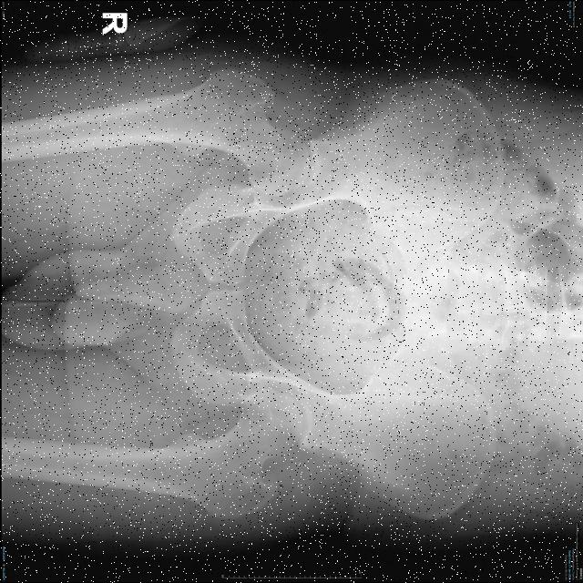 Hip Bones Detection Object Detection Dataset V1 2023 10 18 7 25pm By Tfg