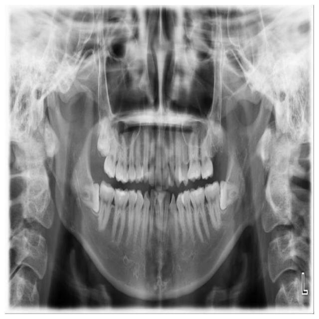 final+impacted tooth Object Detection Dataset by zaxo