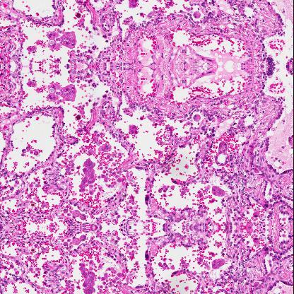 lung_cancer_detection_big data Instance Segmentation Dataset by ...
