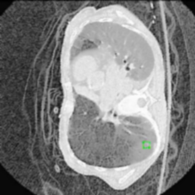 Lung_Cancer_NormAug_Validation Instance Segmentation Dataset by ...