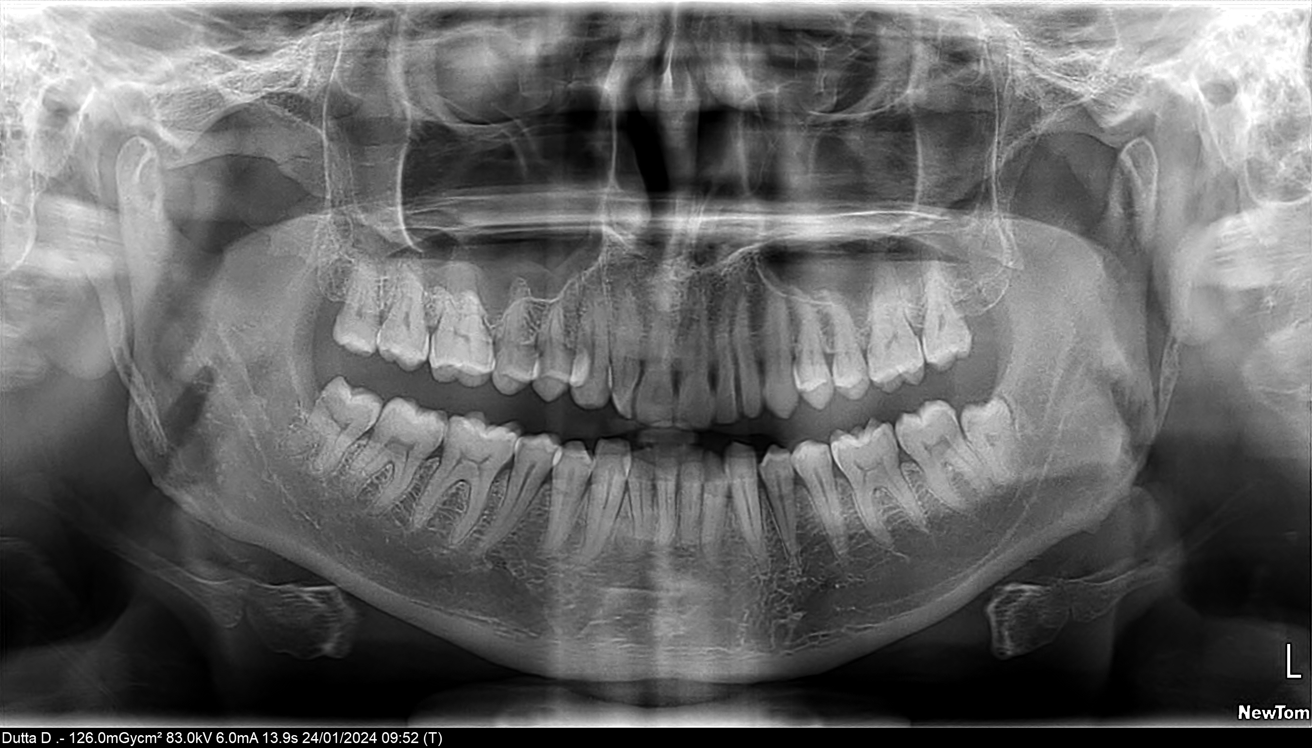 OPG_1 Instance Segmentation Dataset and Pre-Trained Model by opg
