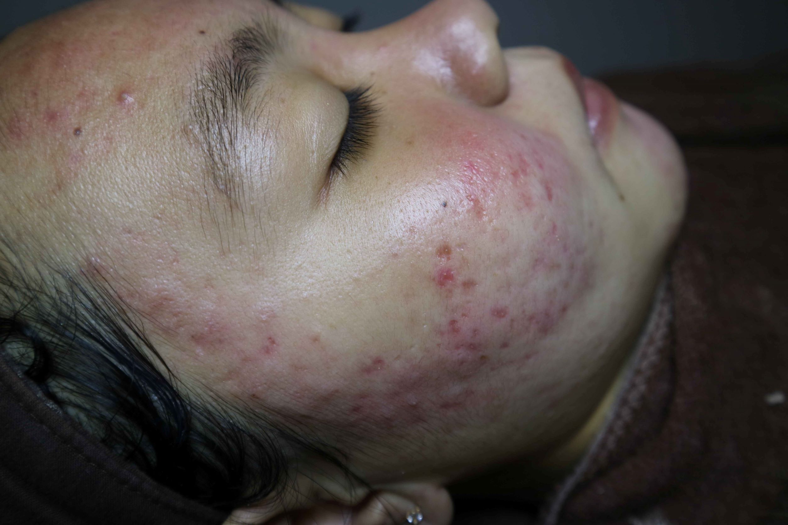 Klinik Object Detection Dataset V1 2022 08 06 8 10pm By Acne Severity