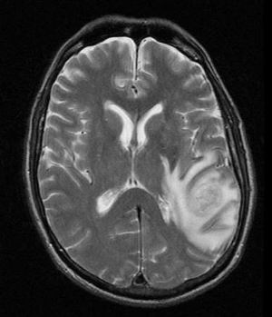 Brain Tumor Detection Object Detection Dataset by sip detection