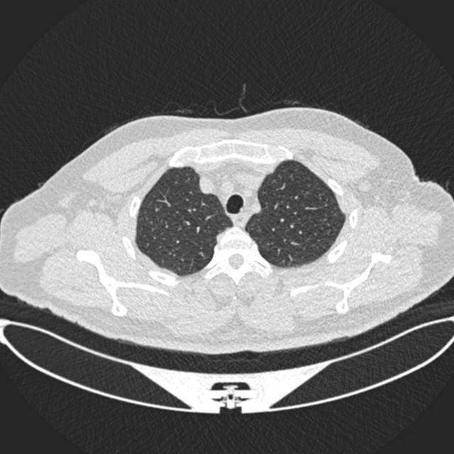 Lung Detect Object Detection Dataset And Pre Trained Model By Yolo