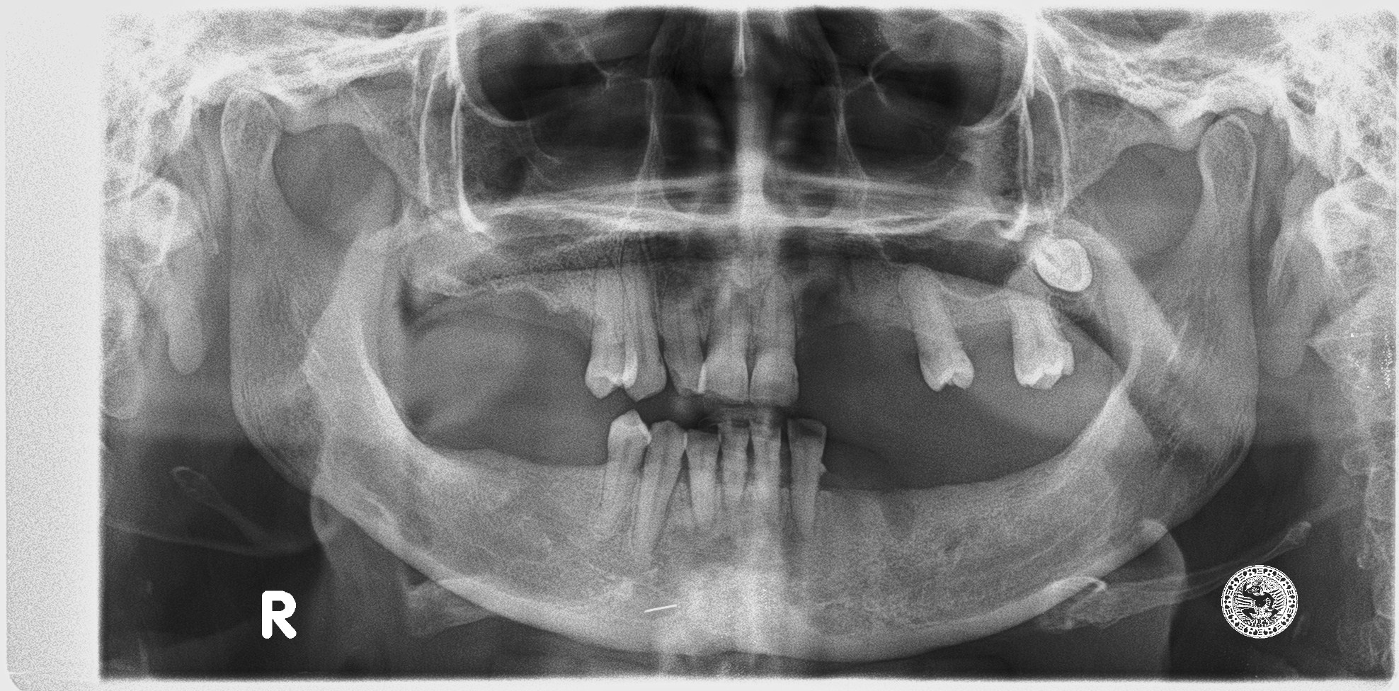 Periodontal Bone Loss Detection Object Detection Dataset By Periodontal Bone Loss