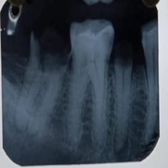 Dental-Diseases Object Detection Dataset and Pre-Trained Model by Dentai