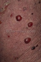 Dermnet dataset - Roboflow Universe