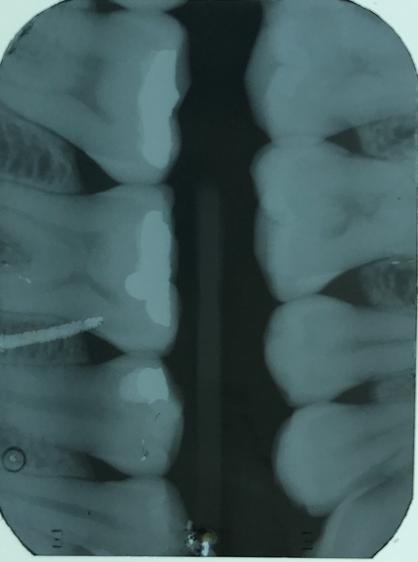 bitewing_left Object Detection Dataset by deneme